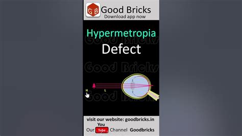 Defects Of Eye Hypermetropia Cbse Telanganaclass 10 Physics