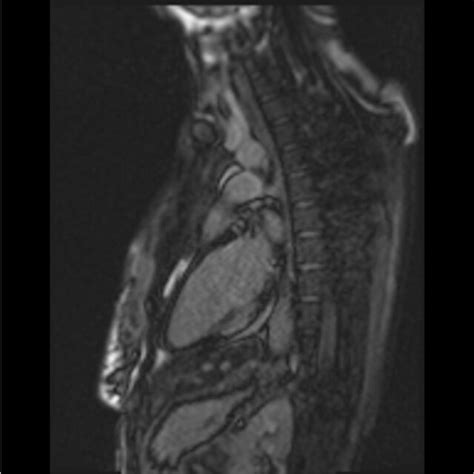 Cardiac Mri Inverse Recovery Lge Sequence Long Axis View Showing