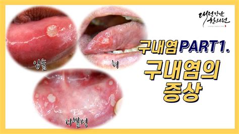 입병 혓바늘이 생겼어요 입안이 아파요 구내염 설염 증상 Youtube