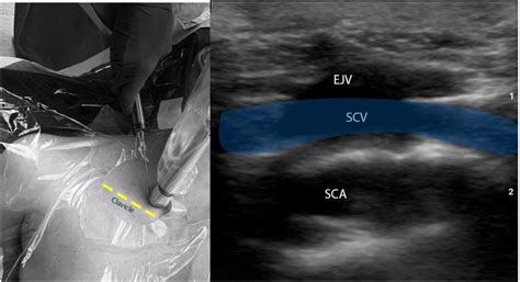Tips And Tricks Us Guided Subclavian Vein Em Ultrasound Section