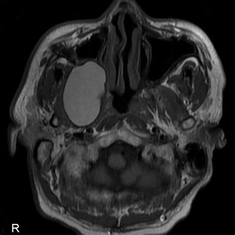 Ncct Pns Axial Section Non Contrast Computed Tomography Ncct Of The Download Scientific