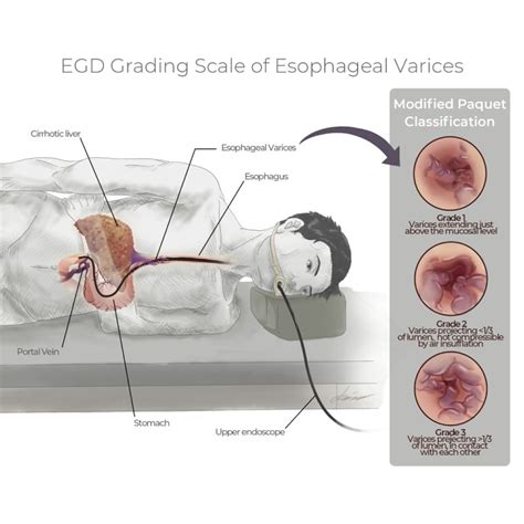 Egd Grading Of Esophageal Varices My Commissioned Artwork The Modified