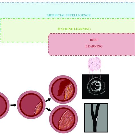 Artificial Intelligence And Imaging Techniques For Symptomatic Plaque
