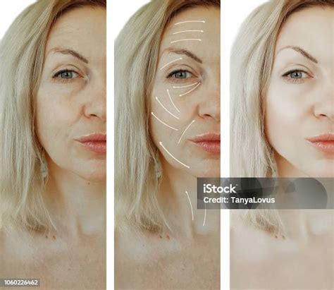 여자 얼굴 주름 절차 전후 화살표 개념에 대한 스톡 사진 및 기타 이미지 개념 개념과 주제 개선 Istock