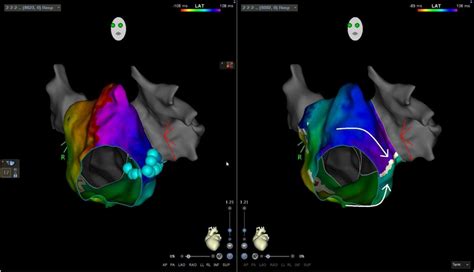 Lateral Mitral Isthmus Ablation Line Pre Ablation And Post Ablation