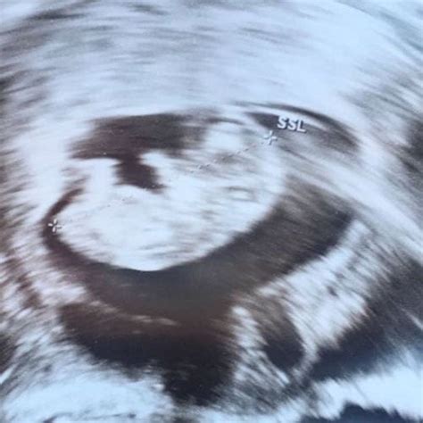 11. SSW: Entwicklung, Symptome und Ultraschallbilder