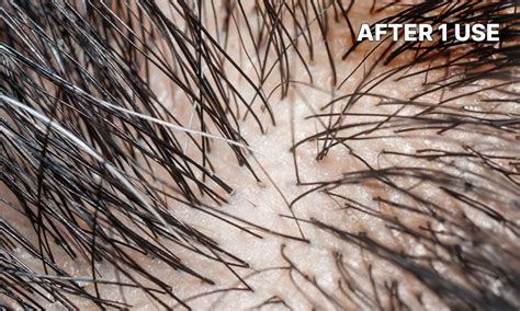 Buy Bare Anatomy Anti Dandruff Shampoo For All Hair Types Online Innovist