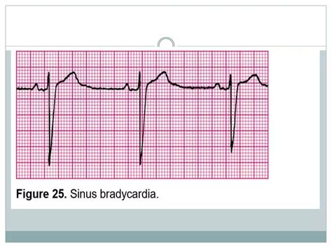 Adult Cardiac Life Support Acls Pptx First Aid Injuries