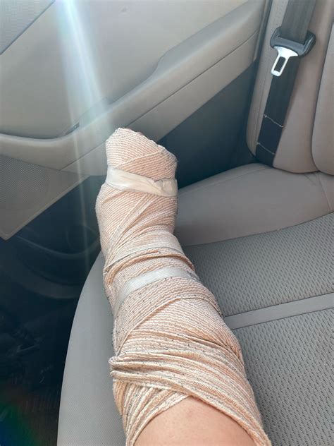Cast Vs Splint Opinions R Brokenbones