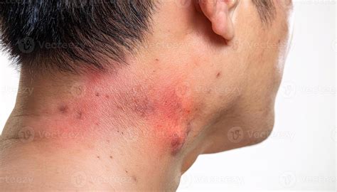Detailed Shot Of Allergic Contact Dermatitis On The Neck Showing