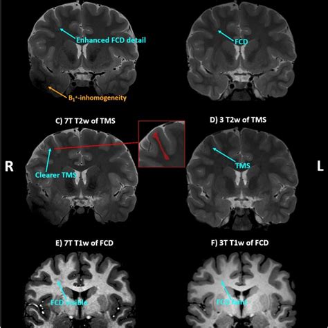 In Patients Such As 24 The 7 T Epilepsy Consensus Protocol Adds Download Scientific Diagram