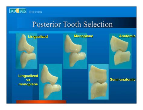 New 22criteria For Posterior Tooth Selection Pdf
