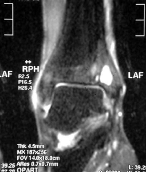 Intraosseous Ganglion Wikidoc