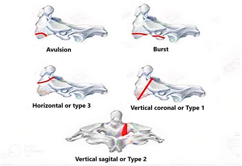 A Rare Case Of C2 Body Type Ii Sagittal Oblique Fracture Case Report