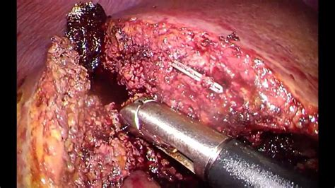 S6 Partial S5 7 Hepatectomy Cholecystectomy In Hcc With Vp2 Tumor Thrombus En Bloc Excision