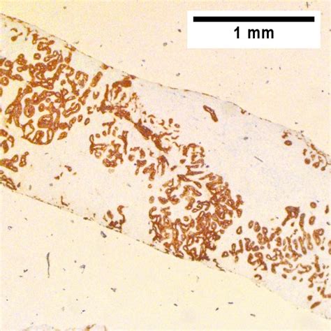 Cholangiocarcinoma Libre Pathology Cholangiocarcinoma Libre Pathology