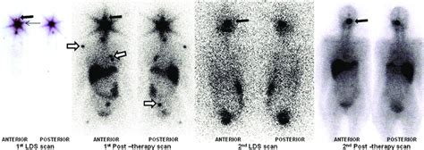 The Post Surgery First Iodine 131 Diagnostic And First Post Therapy