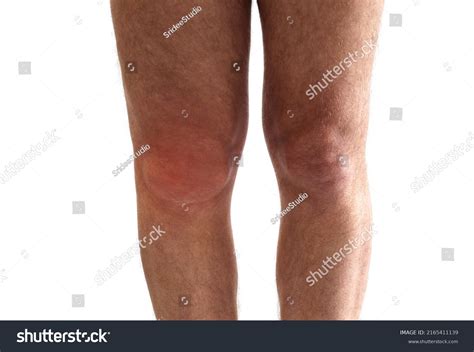 Knee Fluid Images Stock Photos Vectors Shutterstock
