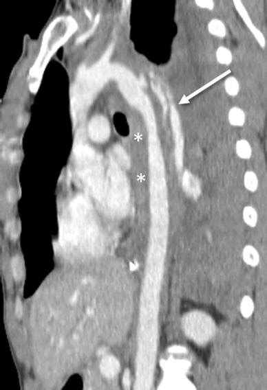 Oblique Sagittal Reconstructed Chest Ct With Intravenous Contrast Image