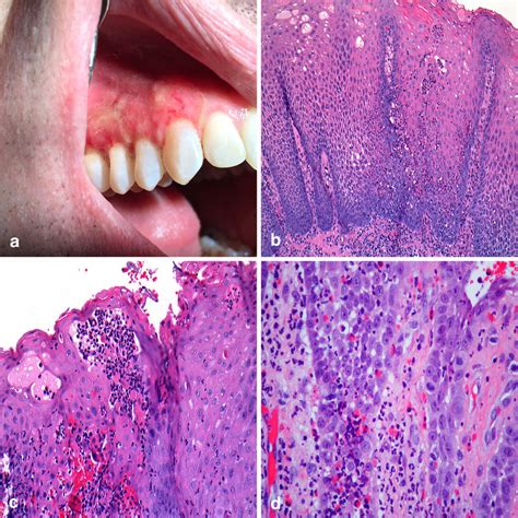 Pyostomatitis Vegetans A Irregular Linear “snail” Tracts Along The