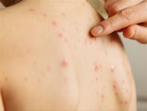 Улаанбурхан өвчний 4 тохиолдол нэмж бүртгэгдлээ