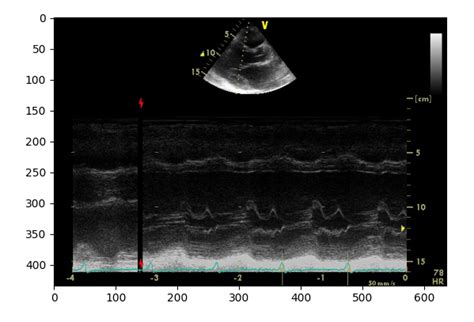 Decompress Jpeg Baseline Process 1 · Issue 1881 · Pydicom Pydicom · Github