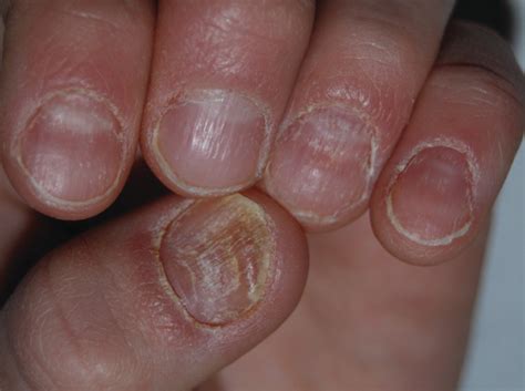 What Causes Lichen Planus Nails And How To Manage It Herbal Care