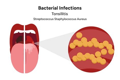 Premium Vector Bacterial Infection Tonsillitis