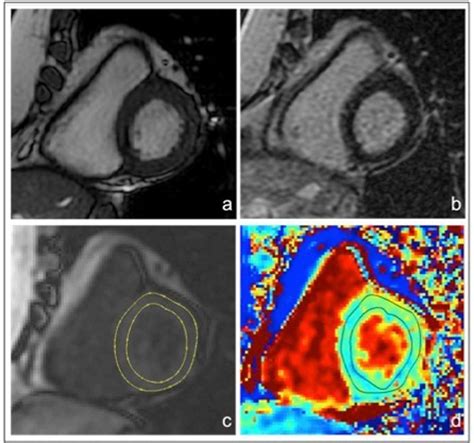 Myocardial Segmentation For Native T1 Maps Corresponding Images A