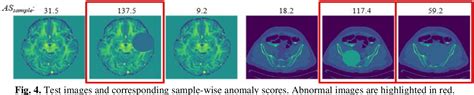 Figure 4 From Anomaly Detection Through Latent Space Restoration Using Vector Quantized