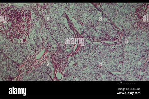 Ovarian Carcinoma Tissue Stock Video Footage Alamy