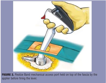 How To Place An Access Port Bariatric Times