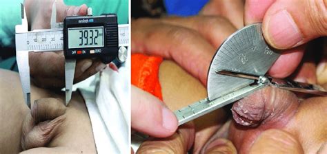 Digital Measuring Scale And Calibrated Angle Metre For Precise Penile Download Scientific