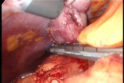 Gastrointestinal Estromal Tumor GIST The Gastrointestinalatlas Gastrointestinalatlas Com