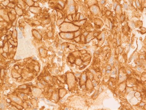 Myeloid Sarcoma 3