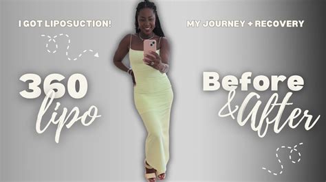 How 360 Lipo Helped Me Beat Graves Disease And Weight Gain Before