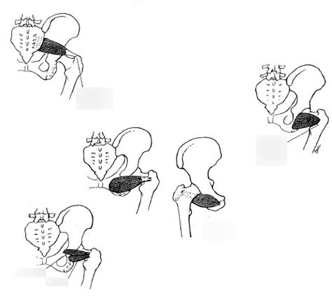 Y Shaped Gluteal Cleft