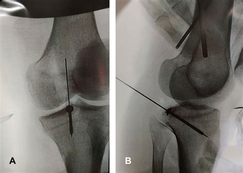 Fractura Avulsión De La Inserción Distal Del Ligamento Cruzado