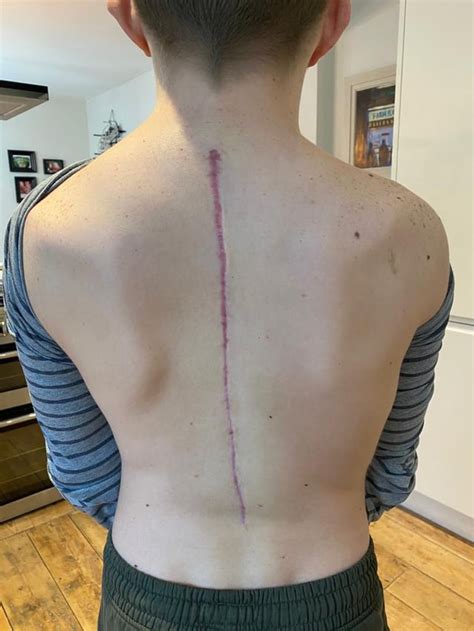 Before After Comparison R Scoliosis