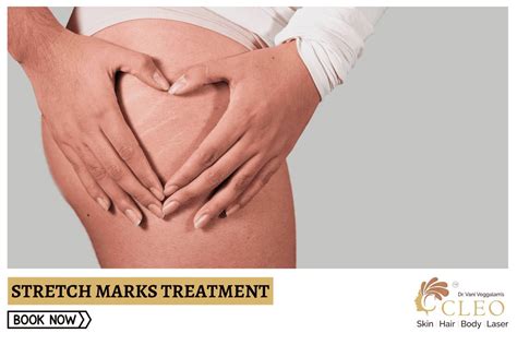 Stretch Marks Treatment Cleo Skin Clinic