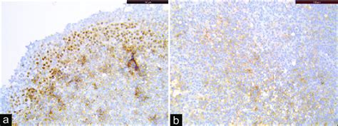 A And B Immunohistochemical Staining With Showing Diffuse Positivity Download Scientific