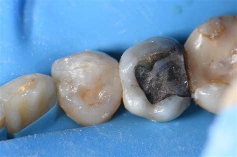 matrix in matrix assembly for complex dental fillings matrix in matrix