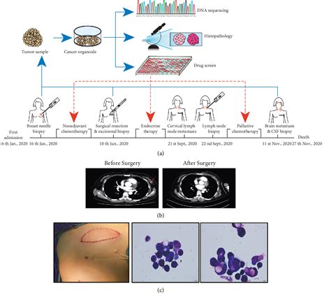 Figure 1 From Combining Organoid Models With Next Generation Sequencing To Reveal Tumor