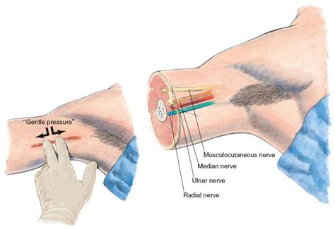 Axillary Block Clinical Tree