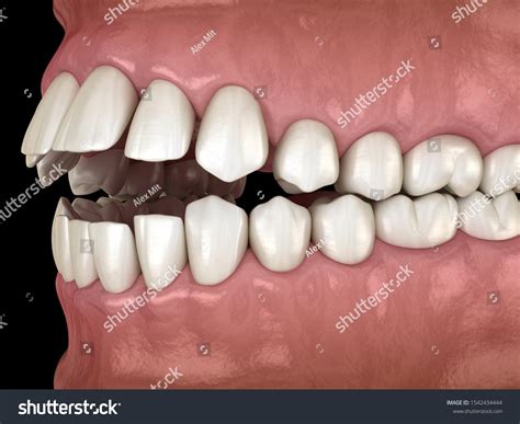 End To End Bite Teeth