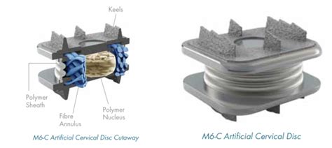 Cervical Disc Replacement The Cutting Edge Of Spinal Surgery Dr Yanni Sergides