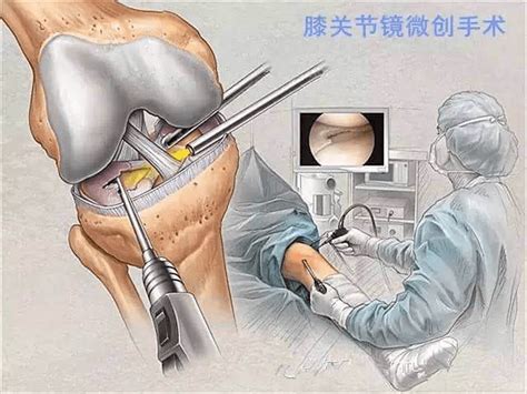 骨科知识前交叉韧带损伤 搜狐大视野 搜狐新闻