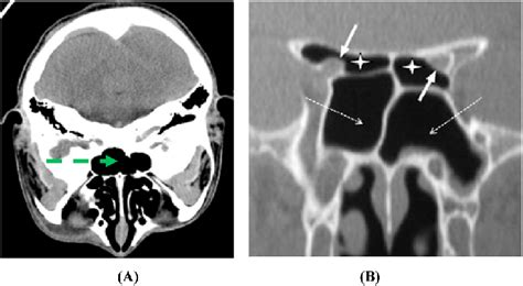 Sagittal Ct Image Showing Sphenoid Sinus Without Inter Sphenoidal