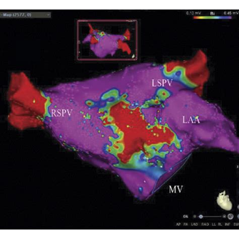 Left Atrial Macroreentry Tachycardia Promoted By Anterior Scar A The Download Scientific