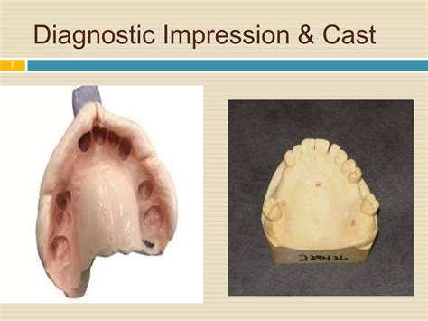 Steps Of Fabrication Of Removable Partial Denture PPTX